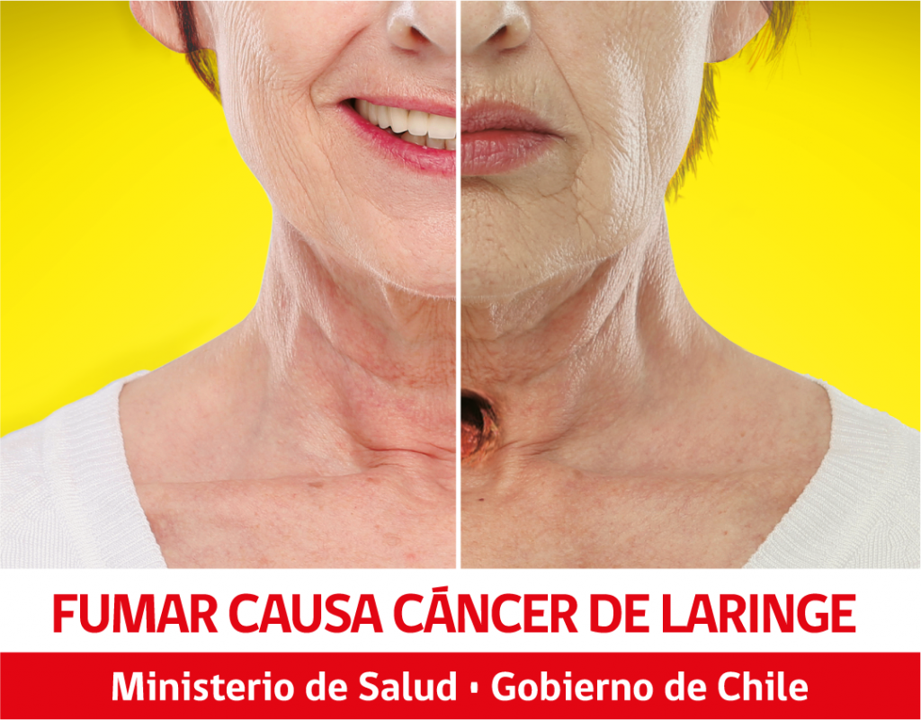 Día Mundial contra el Cáncer: Presentan nuevas advertencias en ...