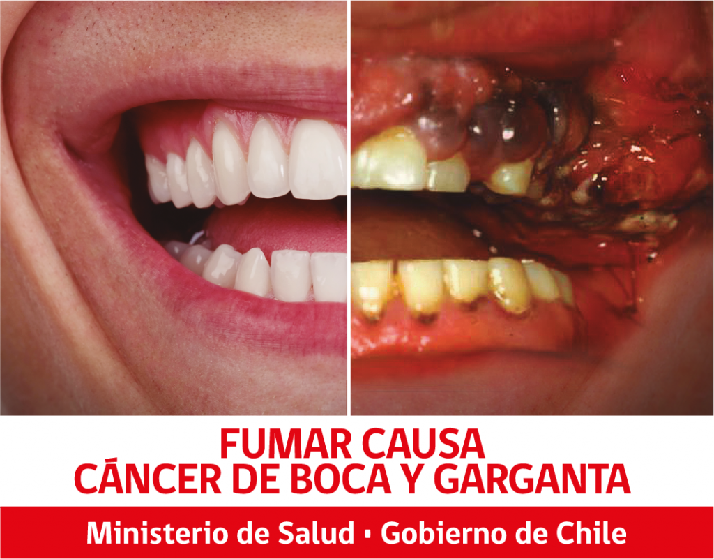 Día Mundial contra el Cáncer: Presentan nuevas advertencias en ...