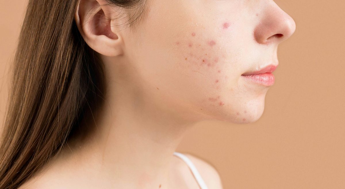 El acné en personas adultas: ¿Por qué aparece y con qué tratamientos se ...